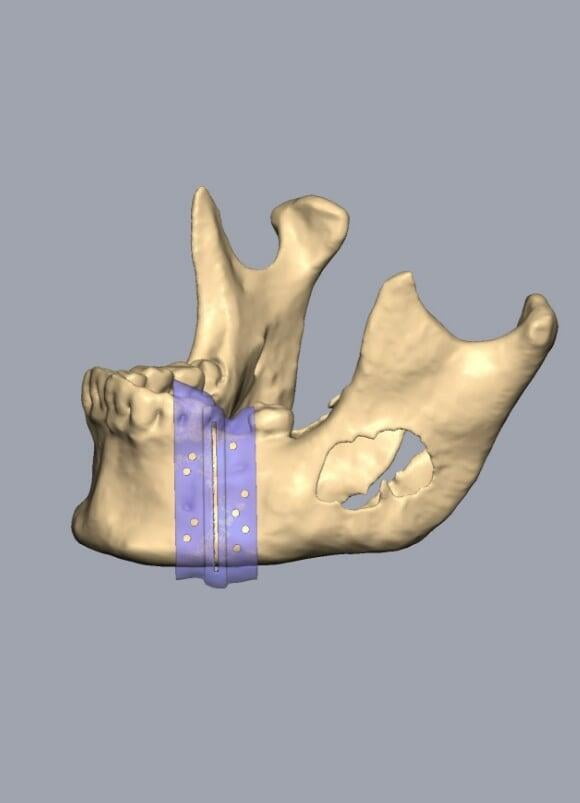 Maxillofacial | LUCID Implants | PSIs for CMF & Ortho